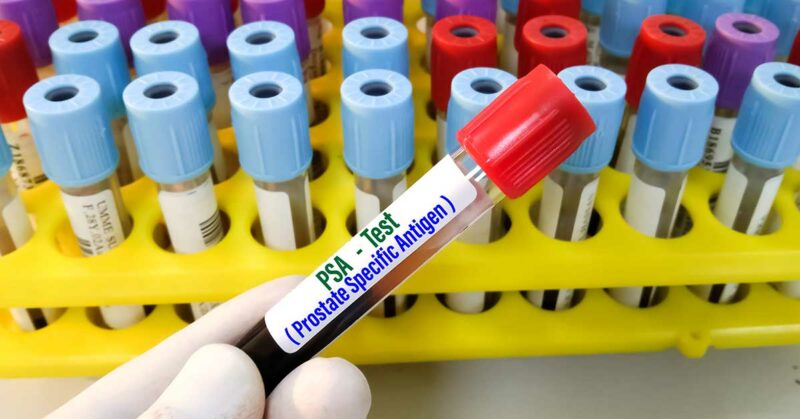 Prostate Cancer - Summary, Symptoms, Treatments